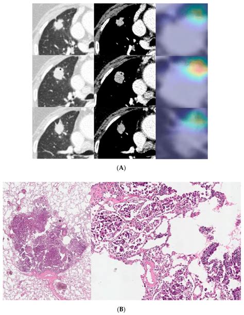 Deep Learning Analysis Of Ct Images Reveals High Grade Pathological Features To Predict Survival