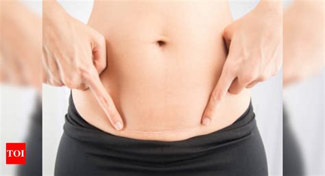 My C Section Scar Is My Badge Of Honor The Times Of India