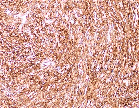 Pathology Outlines Gist