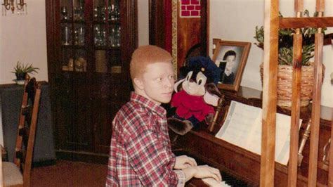 Ser Una Persona Con Albinismo No Es Igual En Europa Que En África Infobae