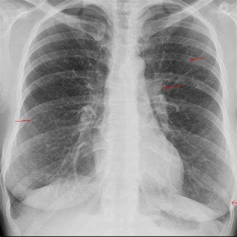 Ms Xs Lung X Ray Showing The Bilateral Pattern Of Reticulo Nodularity Download Scientific