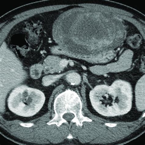 Plexiform Neurofibroma In A 21 Year Old Woman With Neurofibromatosis