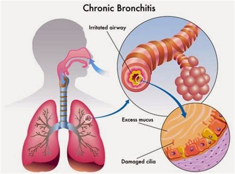 Bronkitis Resep Tradisional Mengobati Penyakit Bronkitis Dan Mengetahui Gelaja Gelaja Penyebabnya