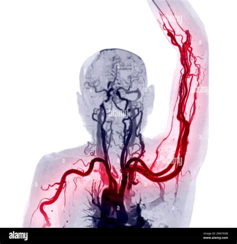 Brachial Arteries Of The Arm With Upper Extremity Bone 3d Rendering