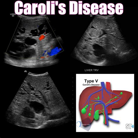 Choledochal Cyst Sonographic Tendencies