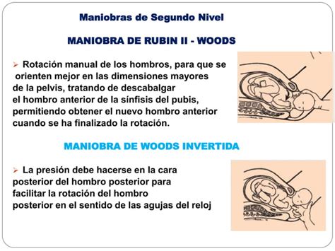 Distocia De Hombros202 Obstetricia 3ppt