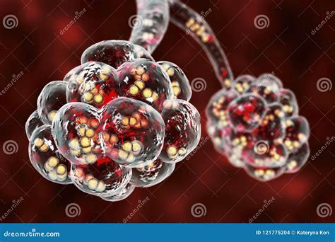 Pneumococcal Pneumonia Medical Concept Stock Illustration