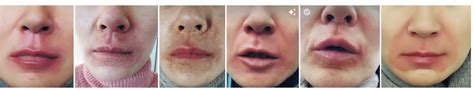 Recurrent Infected Cheilitis → Perioral Dermatitis 7 Months R