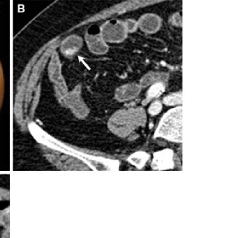 A 53 Year Old Woman With Obscure Gastrointestinal Bleeding Capsule