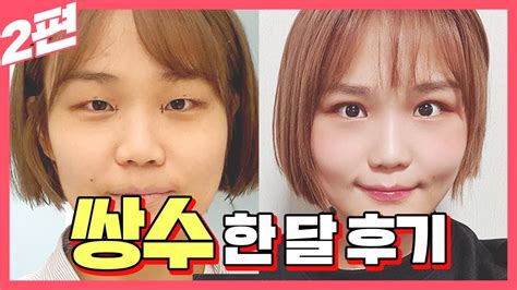 쌍수 한달 후기 쌍꺼풀 수술하고 눈이 2배로 커졌다😍 진작 할 걸 왜 이제야 했지 눈성형 Vlog 2편 쌍수부기쌍수부작용쌍수후기앞트임후기성형브이로그쌍수 후