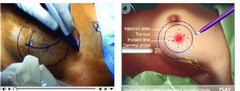 A Lymphatic Mapping With A Radioactive Tracer Download Scientific Diagram