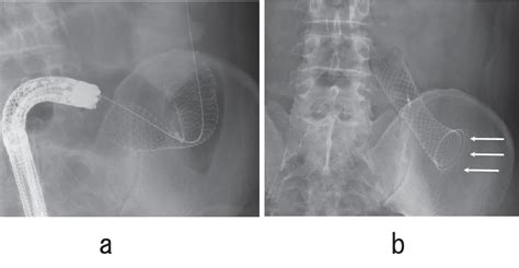 Figure 5 From A Case Of Obstructive Sigmoid Colon Cancer Presented As