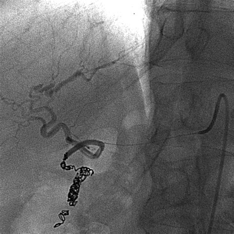Side Branch Embolization Before 90y Radioembolization Rate Of
