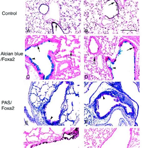 Foxa2 Staining Of Human Lung Tissue With Goblet Cell Hyperplasia A