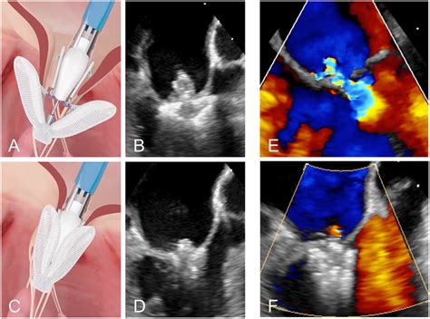 A B Positioning Of The Pascal Device In The Mitral Valve C D