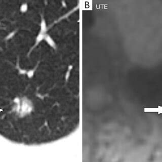 Detection Of Lobulation By UTE And CT A Left Upper Lung