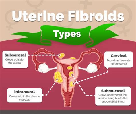 Fibroids Meaning