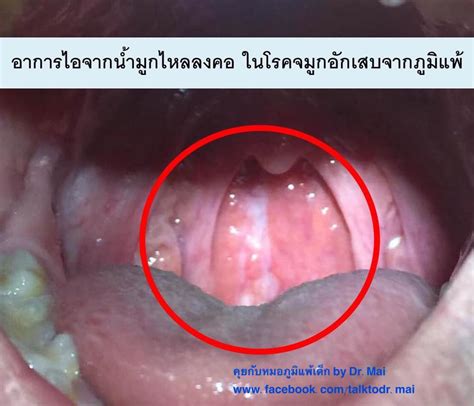 อาการไอจากน้ำมูกไหลลงคอใ คุยกับหมอภูมิแพ้เด็ก By Dr Mai