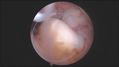 Intraoperative Arthroscopic Image Of Intra Articular Loose Body