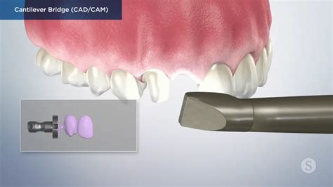 Cantilever Dental Bridge