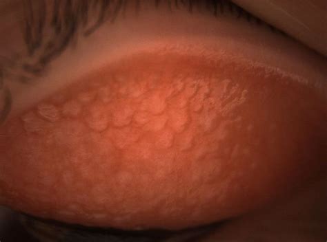 Andrew Price Fbdo Hons Cl Mbcla On Linkedin Yet Another Case Of Ocular