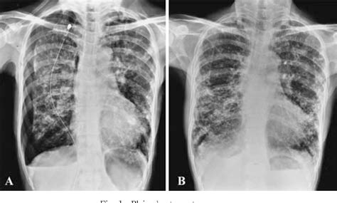 Figure 1 From The Treatment Of Refractory Pneumothorax In Diffuse