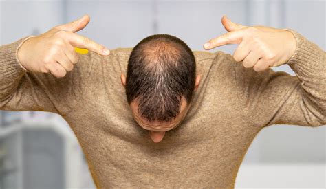 What Is Androgenic Alopecia La Fue Hair New York