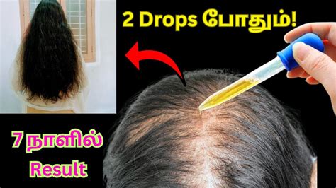 ஒரே வாரத்தில் தலையில் கொட்டிய இடத்தில் முடிகள் காடு மாதிரி வளரும்