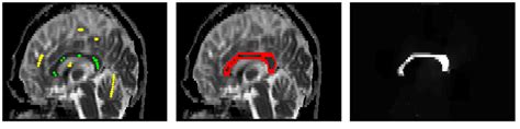 Segmentation Of A Real Dt Mri Brain Dataset Initial With Seeds Download Scientific Diagram