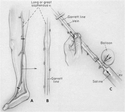 Saphenous Vein Bypass Grafts For Giant Aneurysms And Intracranial