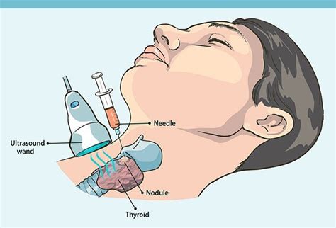 Thyroid Cysts Dr Jeeve ENT Specialist