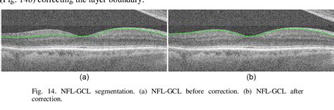 Figure 1 From Automatic Segmentation Of Seven Retinal Layers In Sdoct Images Congruent With