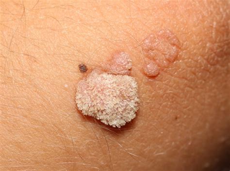 Verruca Definition Causes Signs Symptoms Diagnosis Treatment