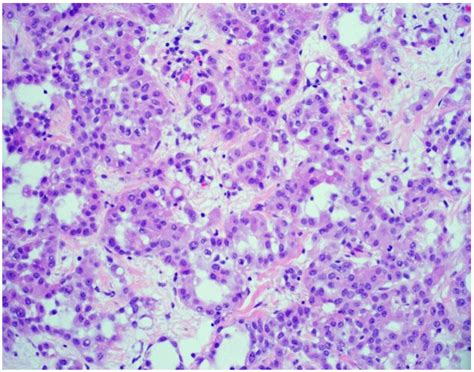 Epithelioid Mesothelioma Characterized By A Proliferation Of Tumor