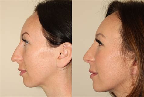 129 Rhinoplasty Dr Denton