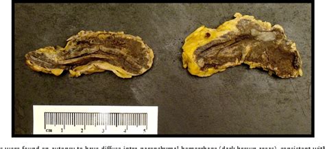 Figure 1 From Fatal Purpura Fulminans And Waterhouse Friderichsen