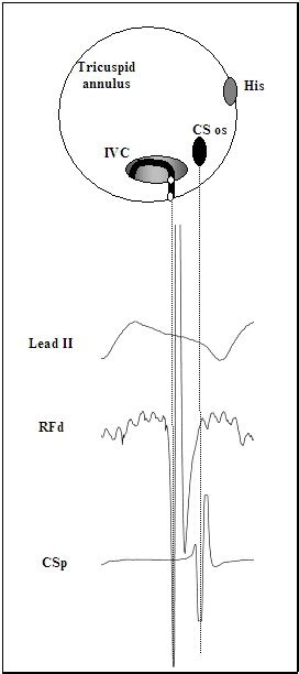 An Approach To Catheter Ablation Of Cavotricuspid Isthmus Dependent Atrial Flutter Pmc
