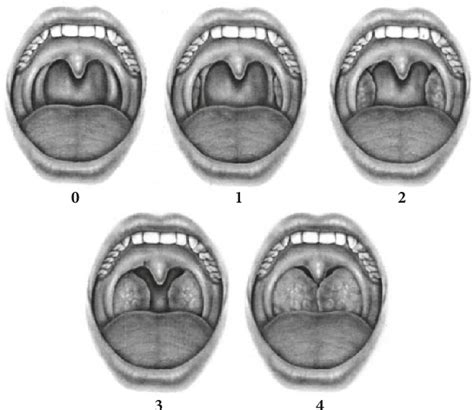 [pdf] Correlation Between Brodsky Tonsil Scale And Tonsil Volume In Adult Patients Semantic