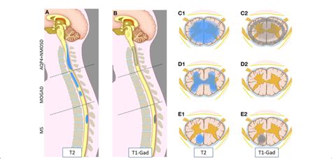 Figure E Schematic Representation Of Myelitis Lesion Location And