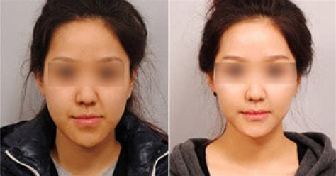 긴 얼굴 양악수술로 4mm만 줄여도 변화