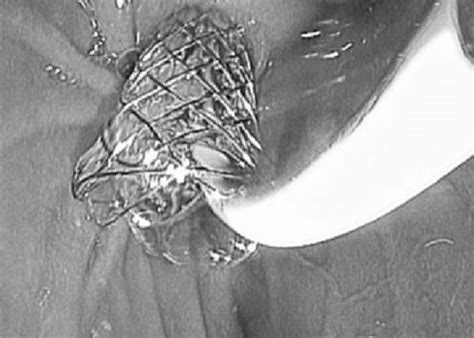 Surgical Procedure Of Ercp In The Treatment Of Biliary Strictures After