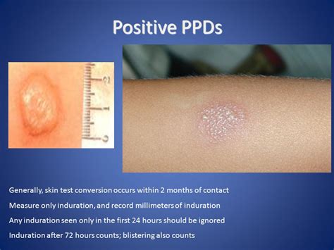 Pediatric Tuberculosis Update Ppt Download