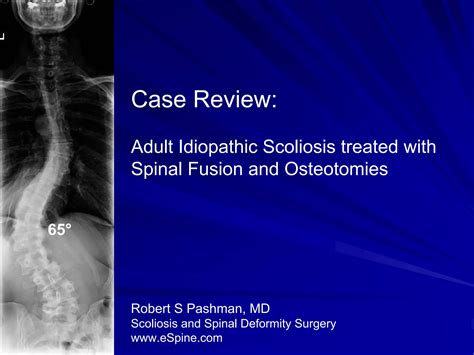 Case Review 15 Adult Scoliosis Treated With Spinal Fusion And