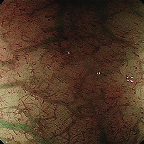 Original Intrapapillary Capillary Loop Ipcl Pattern Classification