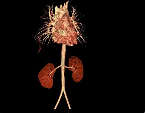 سی تی انجیوگرافی Cta مرکز تشخیصیه و ایمیجینگ طبی حکمت Facebook