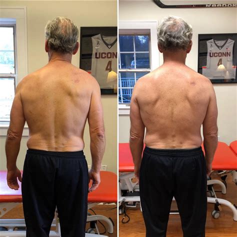 Core Stability Archives Total Physical Therapy