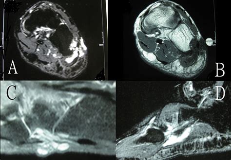 Abductor Digiti Minimi Mri