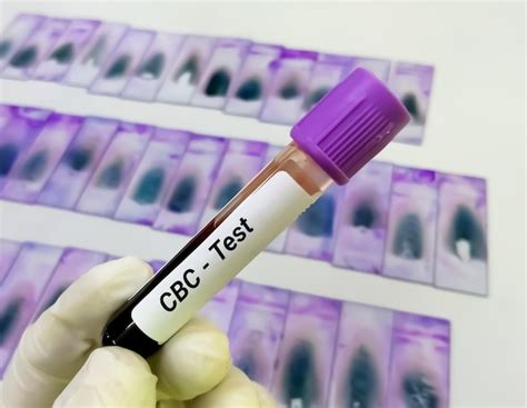 Premium Photo Blood Sample For Cbc Or Complete Blood Count Test