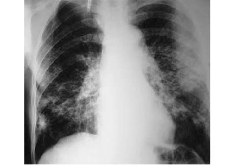 Chest Radiograph Bilateral Diffuse Interstitial Infiltrate Download Scientific Diagram
