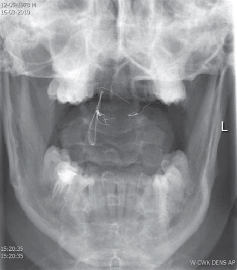 Rtg Photo Of Dens Preoperative Download Scientific Diagram